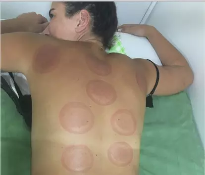 Isebenza Kanjani I-Cupping Therapy? Ngizamile Futhi Iqolo Lami Alikaze Lizizwe Lingcono 2020_5