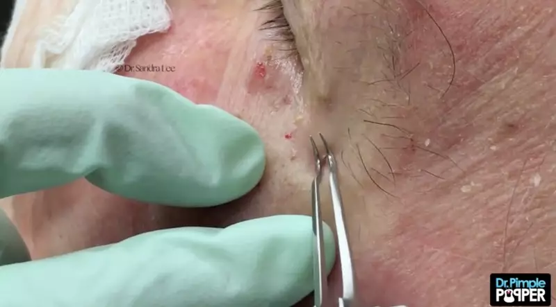 Dr. Pimple Popper hat krekt har eigen blackhead pincet frijlitten - en hjir is hoe't se wurkje 223657_1