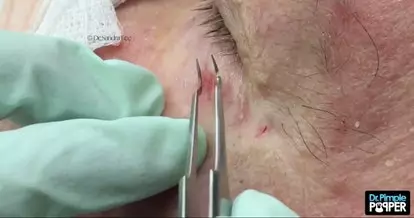 Dr. Pimple Popper hat krekt har eigen blackhead pincet frijlitten - en hjir is hoe't se wurkje 223657_3